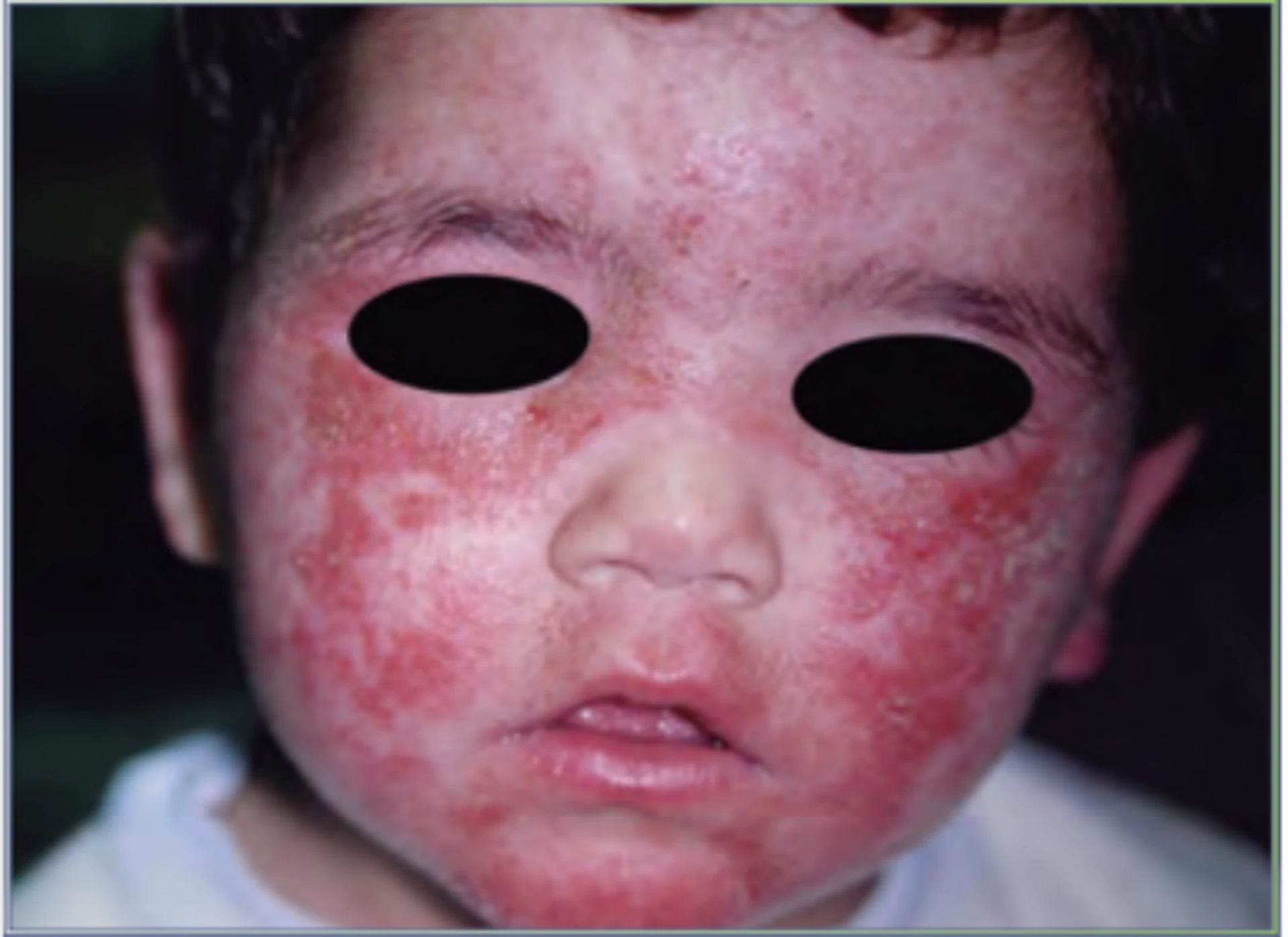 Dermatitis Atópica