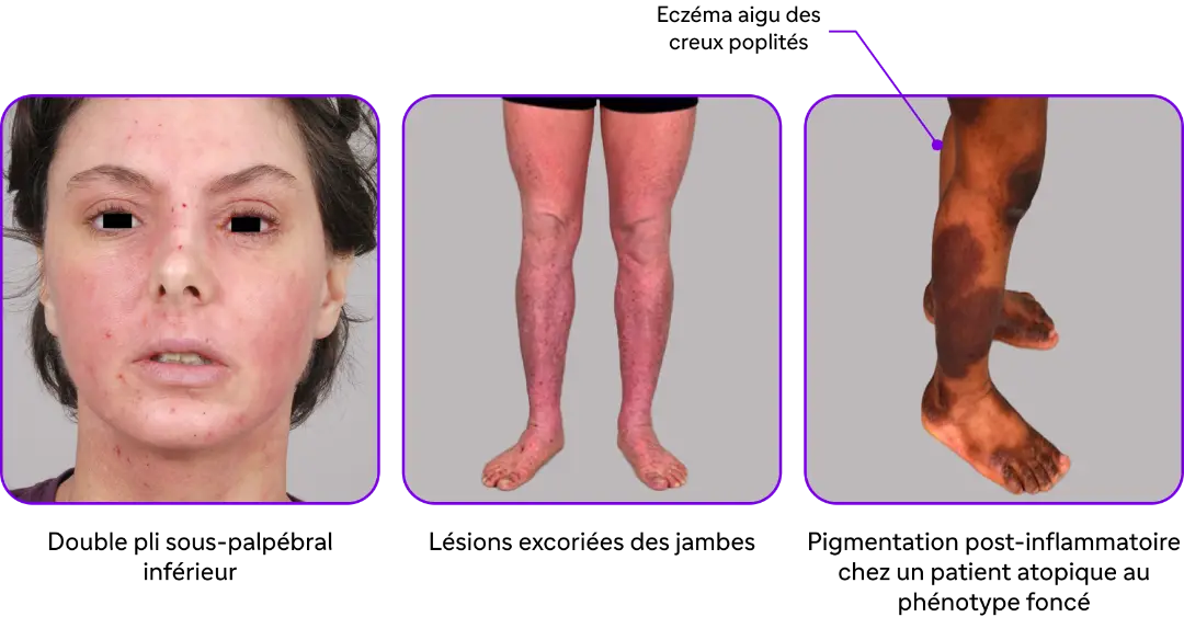 Poser des mots sur la maladie : diagnostiquer la dermatite atopique