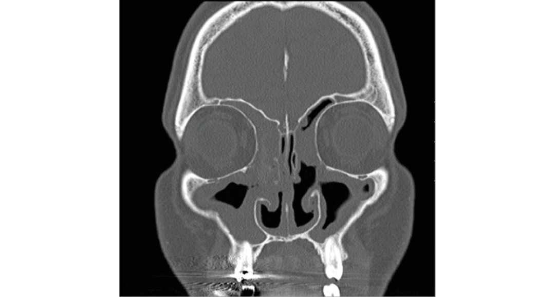 Quels outils pour évaluer la polypose naso-sinusienne