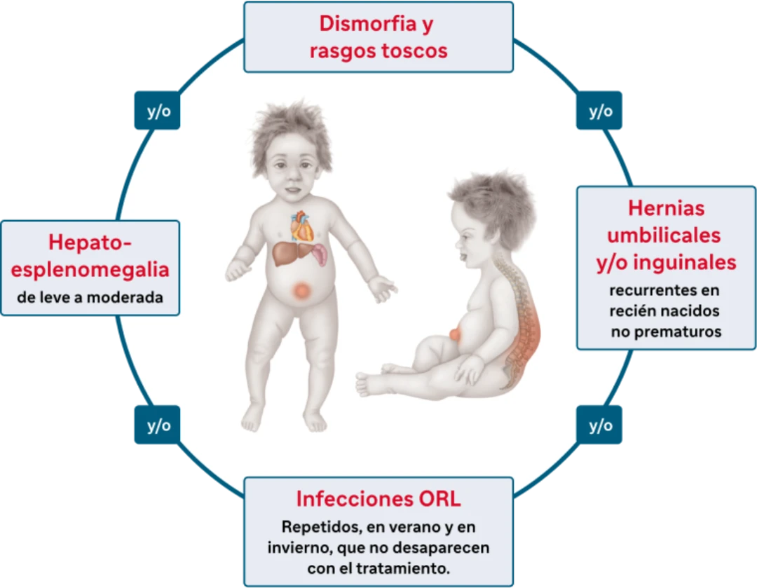 Signos y síntomas de la MPS-I