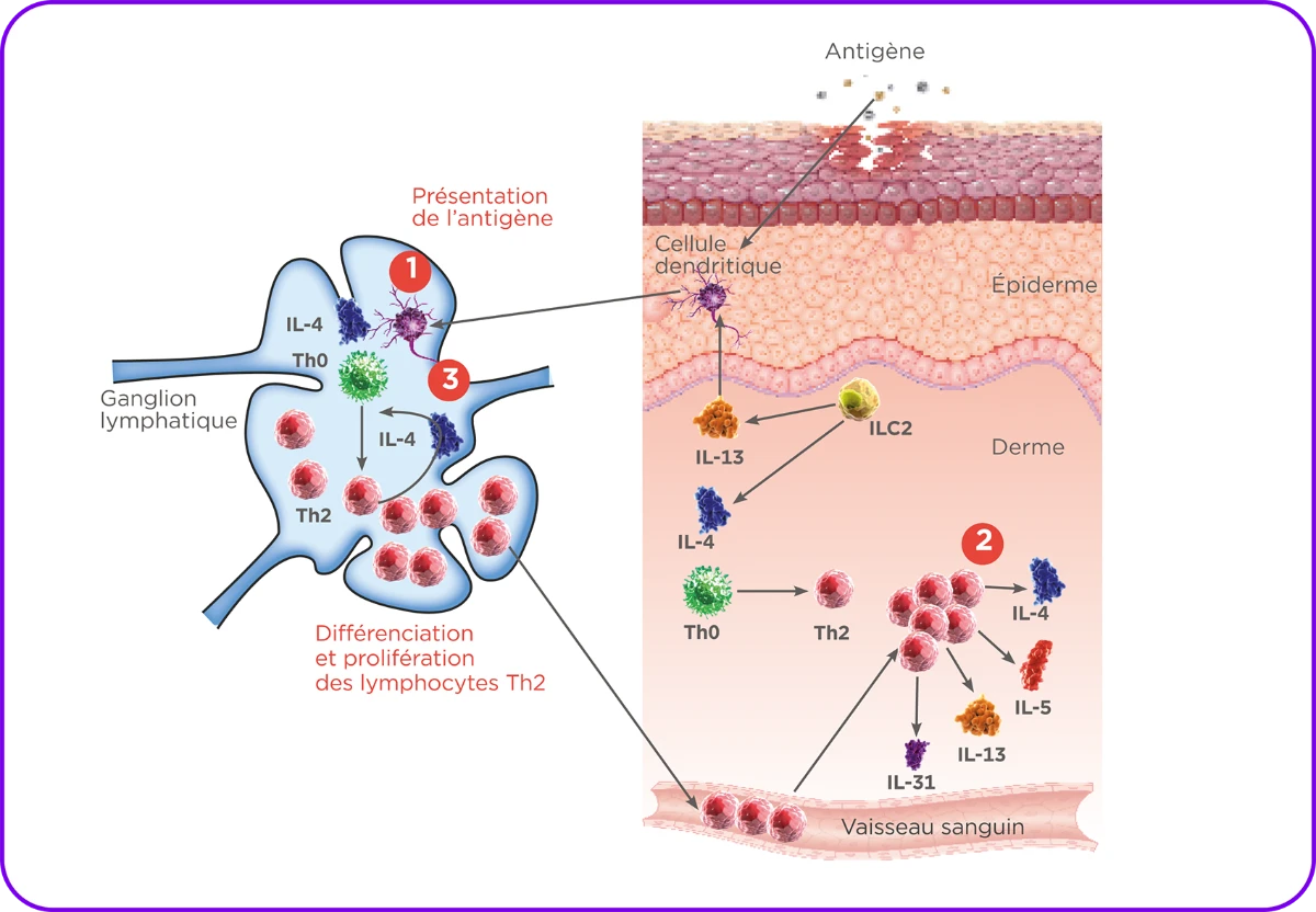 La physiopathologie de la dermatite atopique