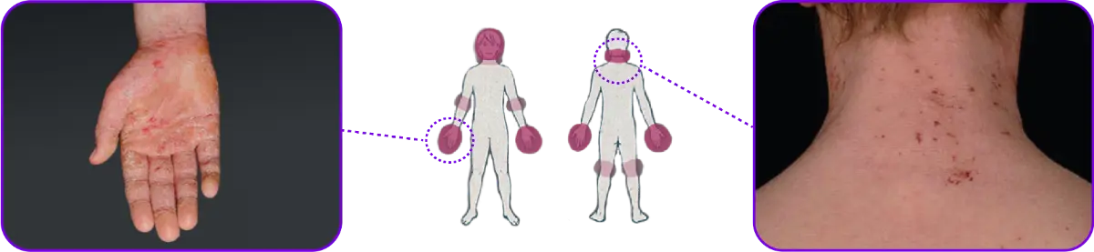 Poser des mots sur la maladie : diagnostiquer la dermatite atopique
