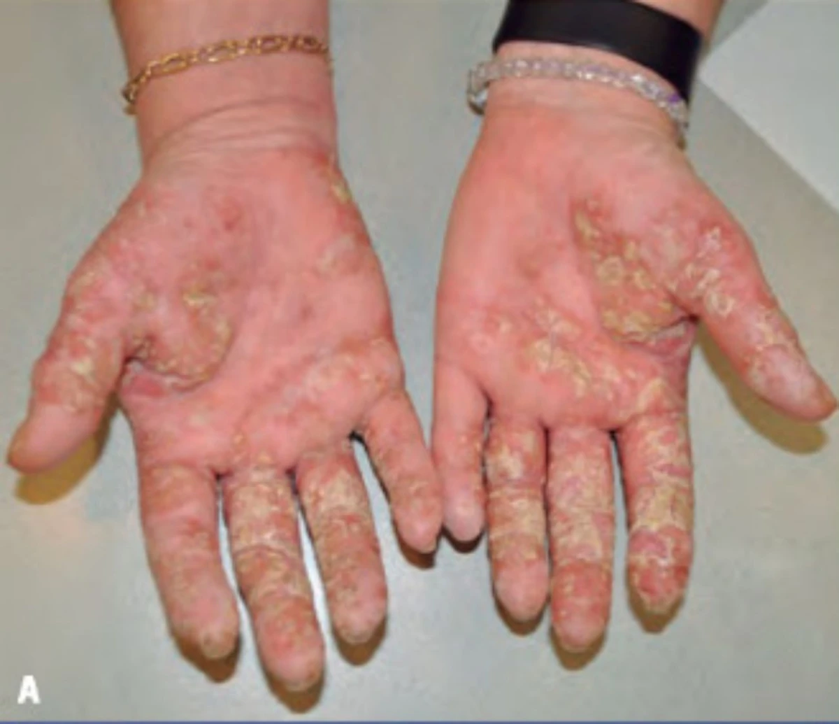 Principios básicos del tratamiento| Campus Sanofi