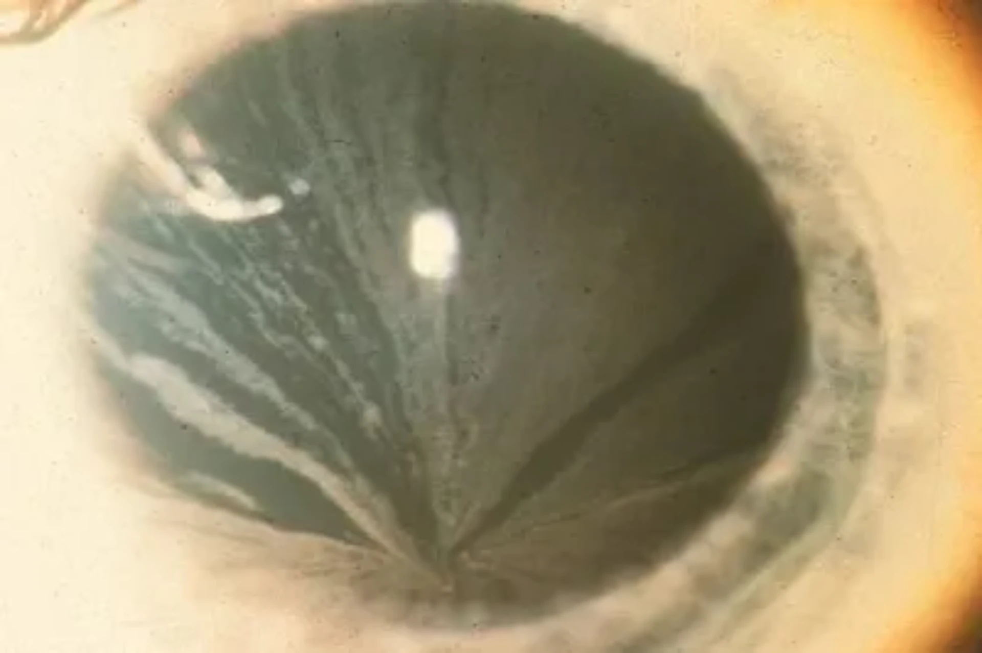 Cornée verticillée : avez-vous exclu une maladie de Fabry