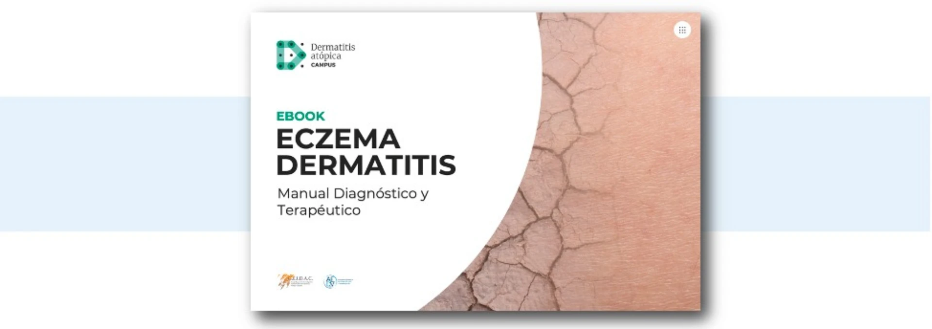eBook: Eczema - Dermatitis, Manual diagnóstico y terapéutico