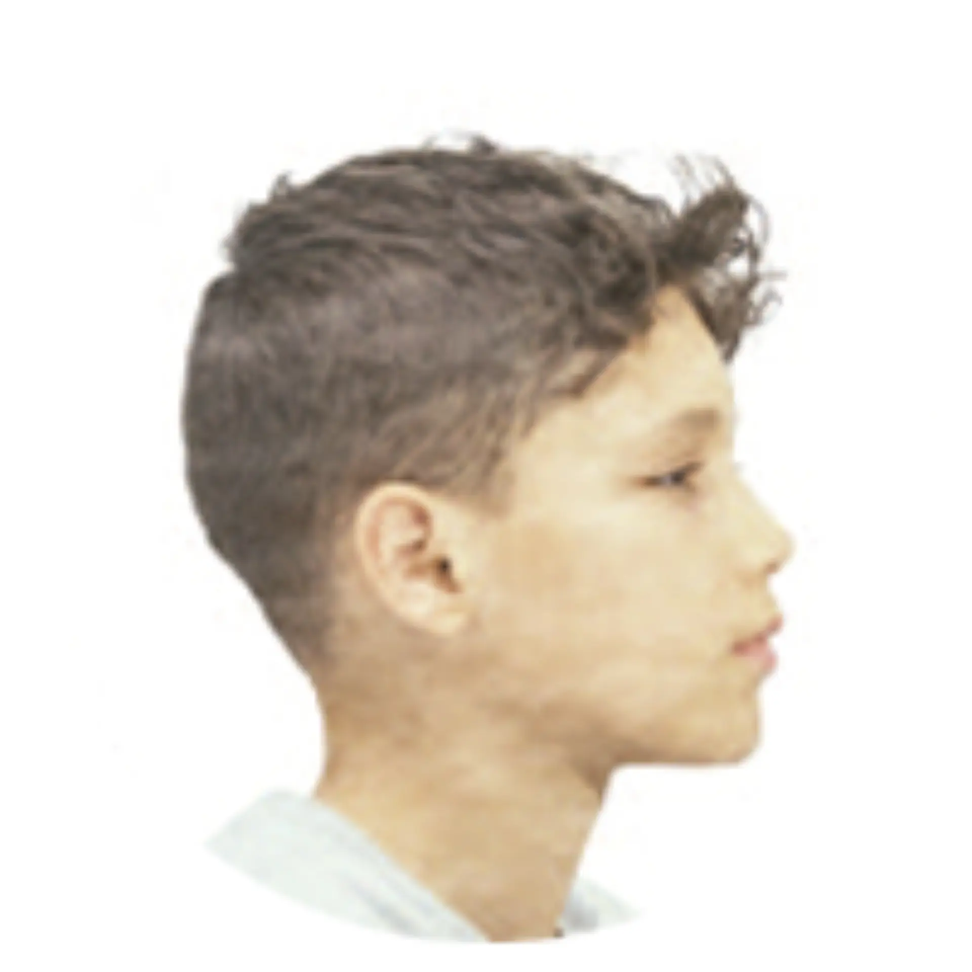 Signos y síntomas en la enfermedad de Fabry | Campus Sanofi