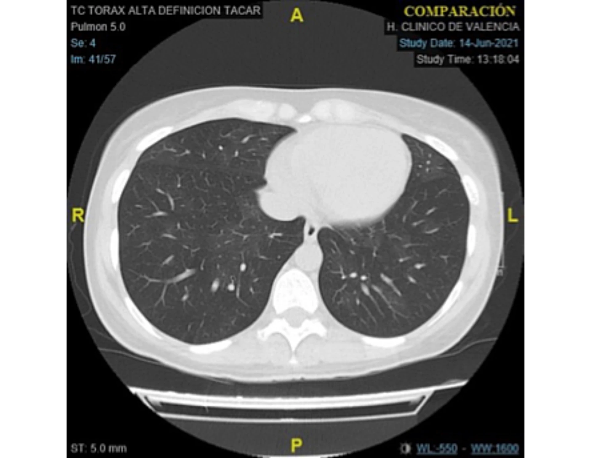Retos en EICRc pulmonar
