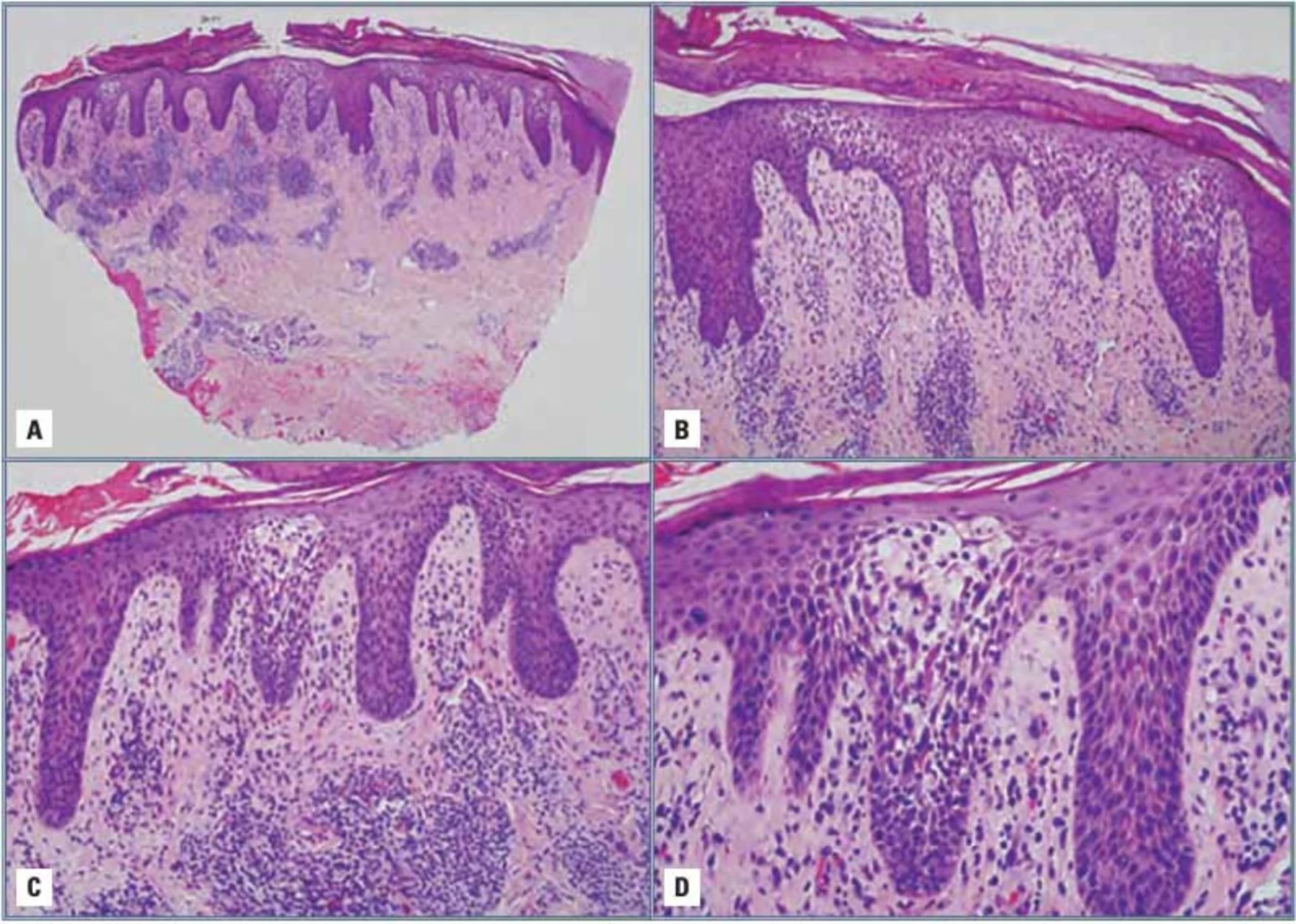 Eczema vs. Dermatitis Atópica