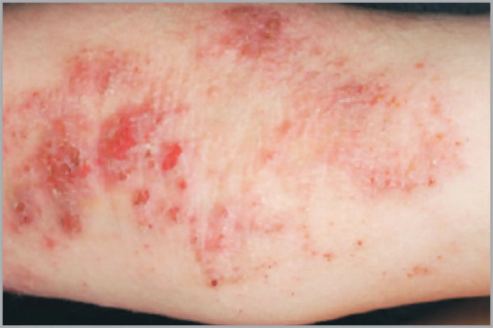 Cuidados en dermatitis crónica | Campus Sanofi