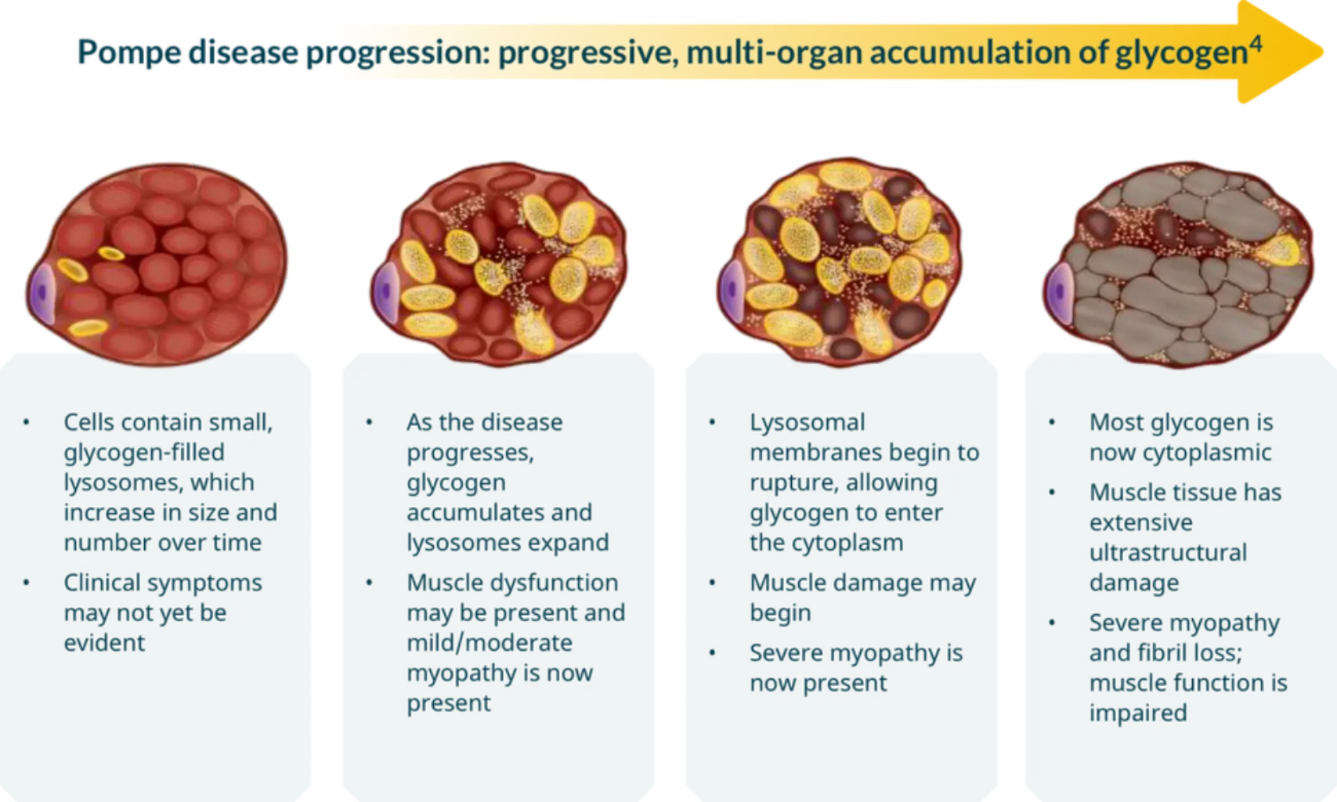 What is Pompe disease?