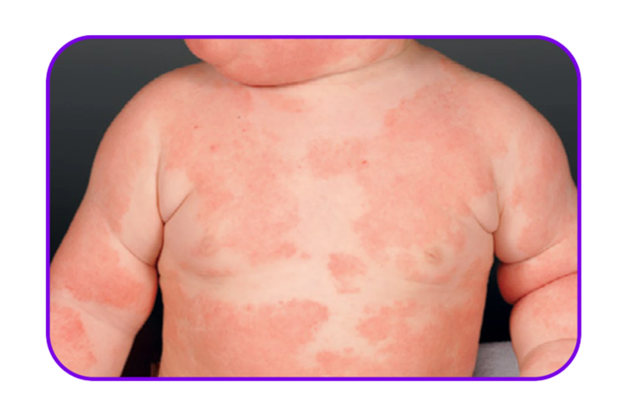 La dermatique atopique chez l’enfant et l’adolescent