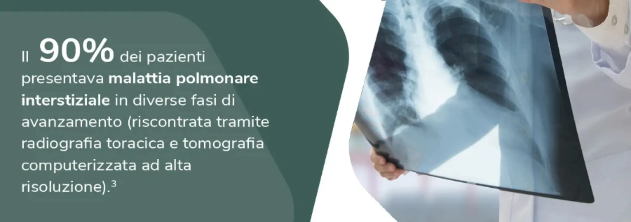 Coinvolgimento polmonare | Sanofi Campus Italia