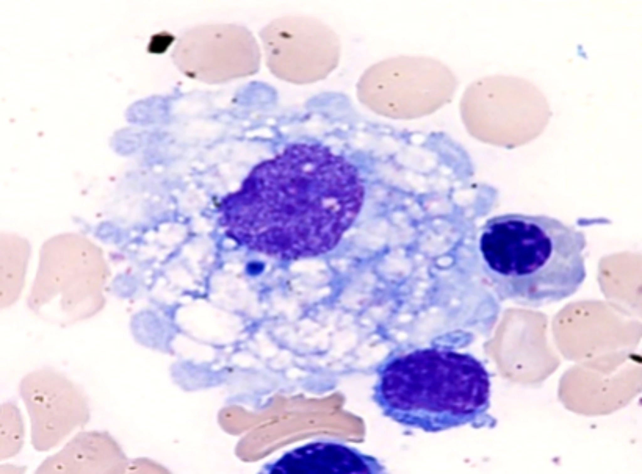 ASMD: el camino hacia su diagnóstico