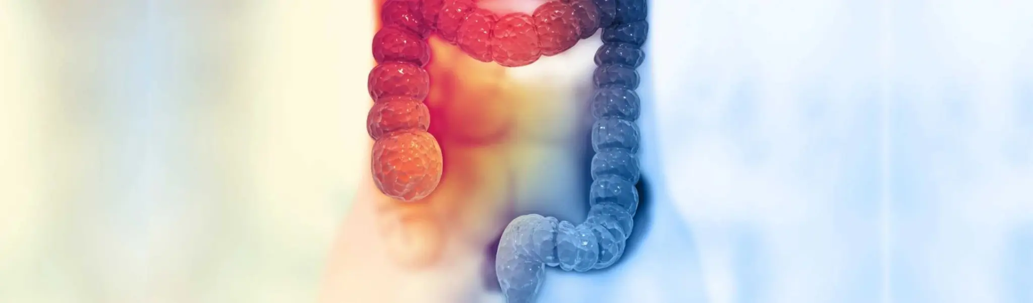 Tratamiento adyuvante del cáncer de colon estadios II-III