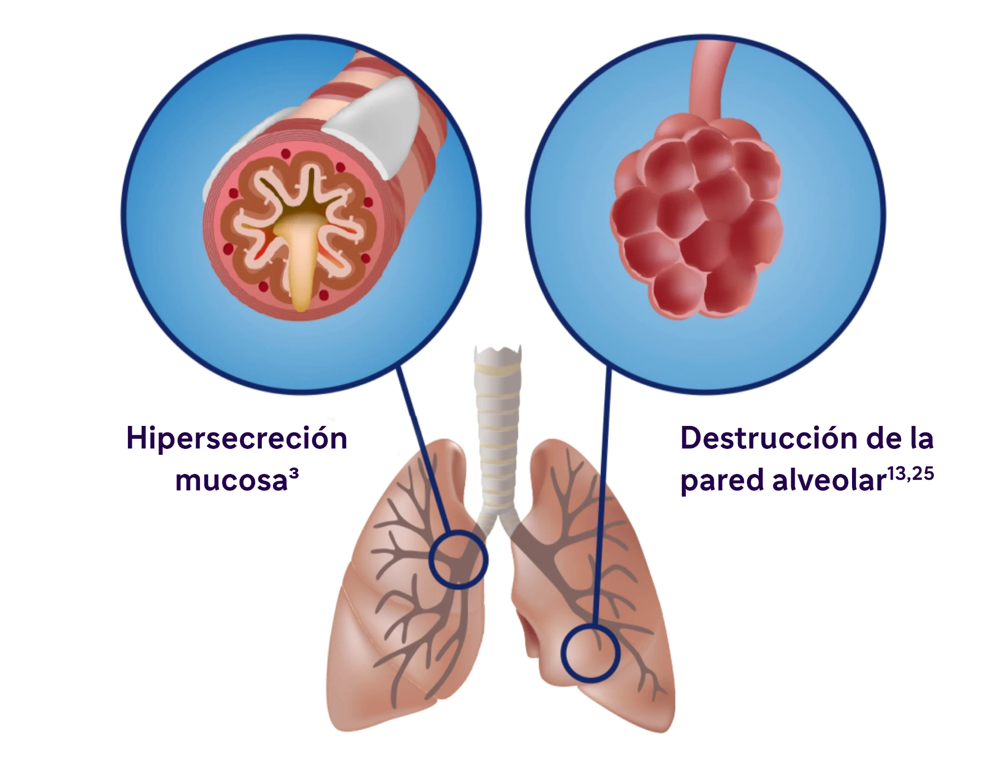 Inflamación de tipo 2 en la EPOC, descubre su impacto