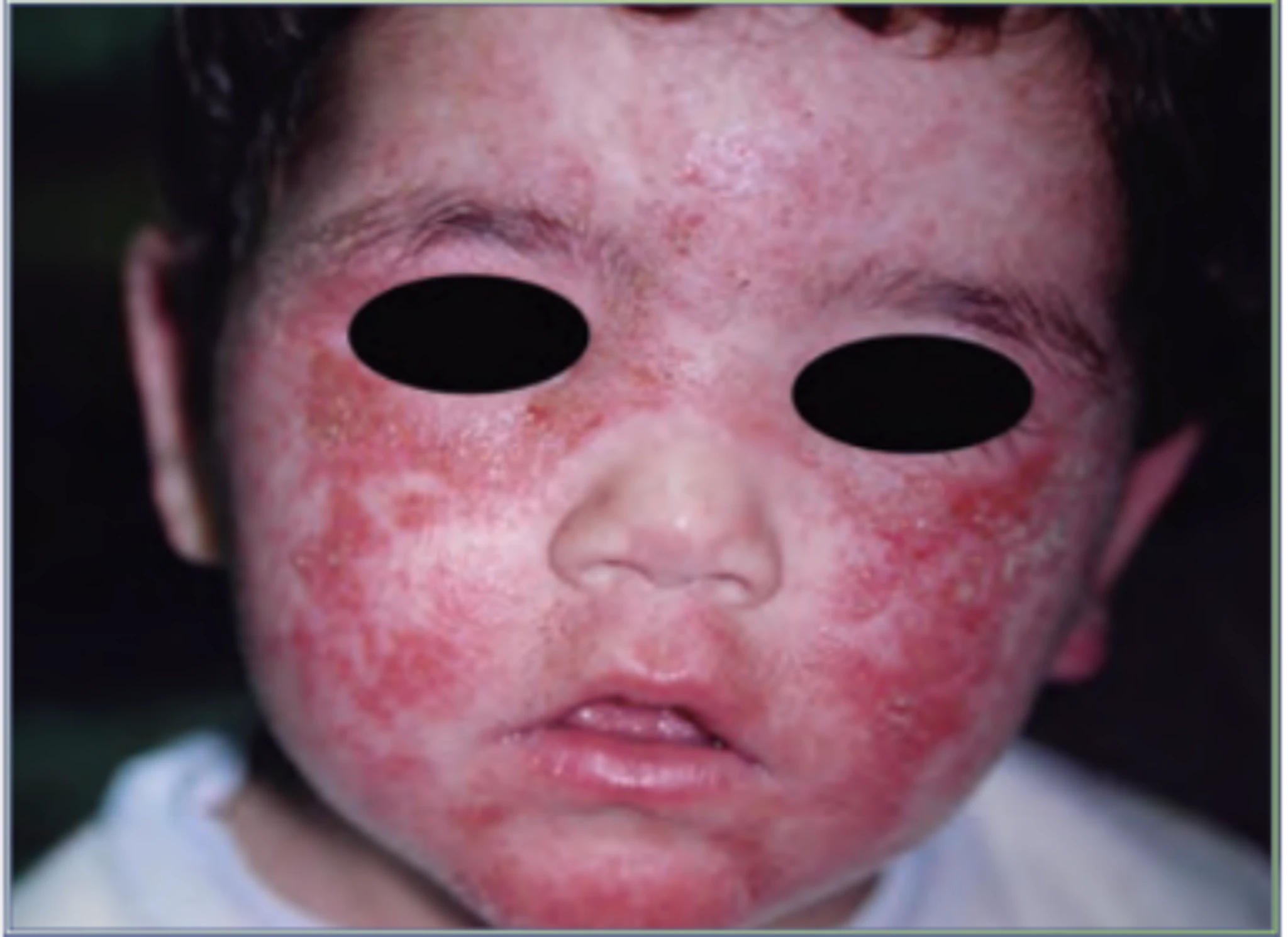 Dermatitis atópica: concepto, diagnóstico y abordaje clínico