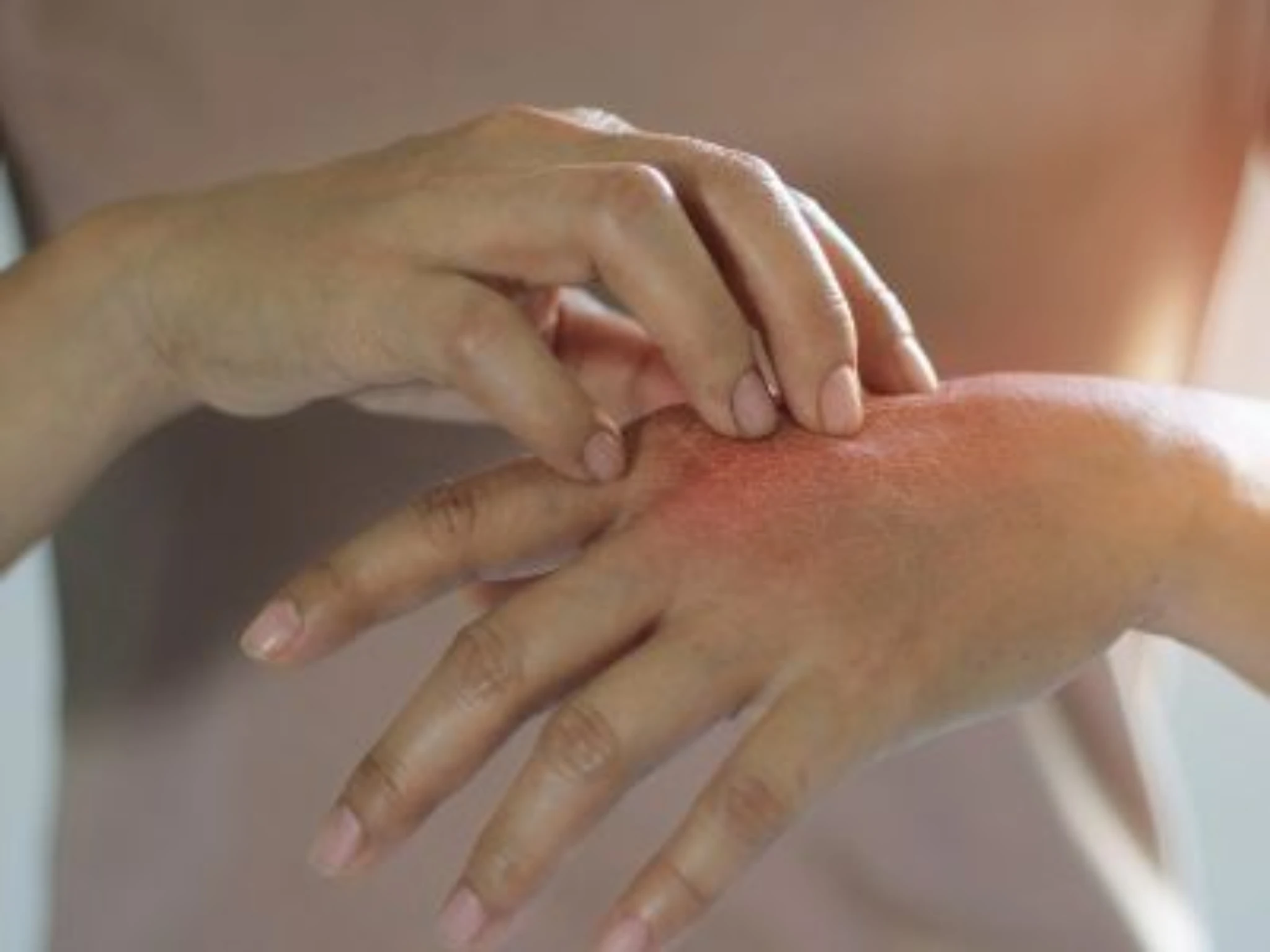 Dermatitis atópica en pacientes | Campus Sanofi