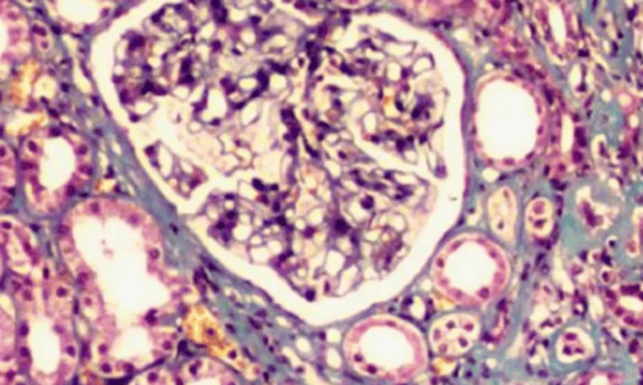 Actualidad médica en Enfermedad de Fabry | Campus Sanofi España