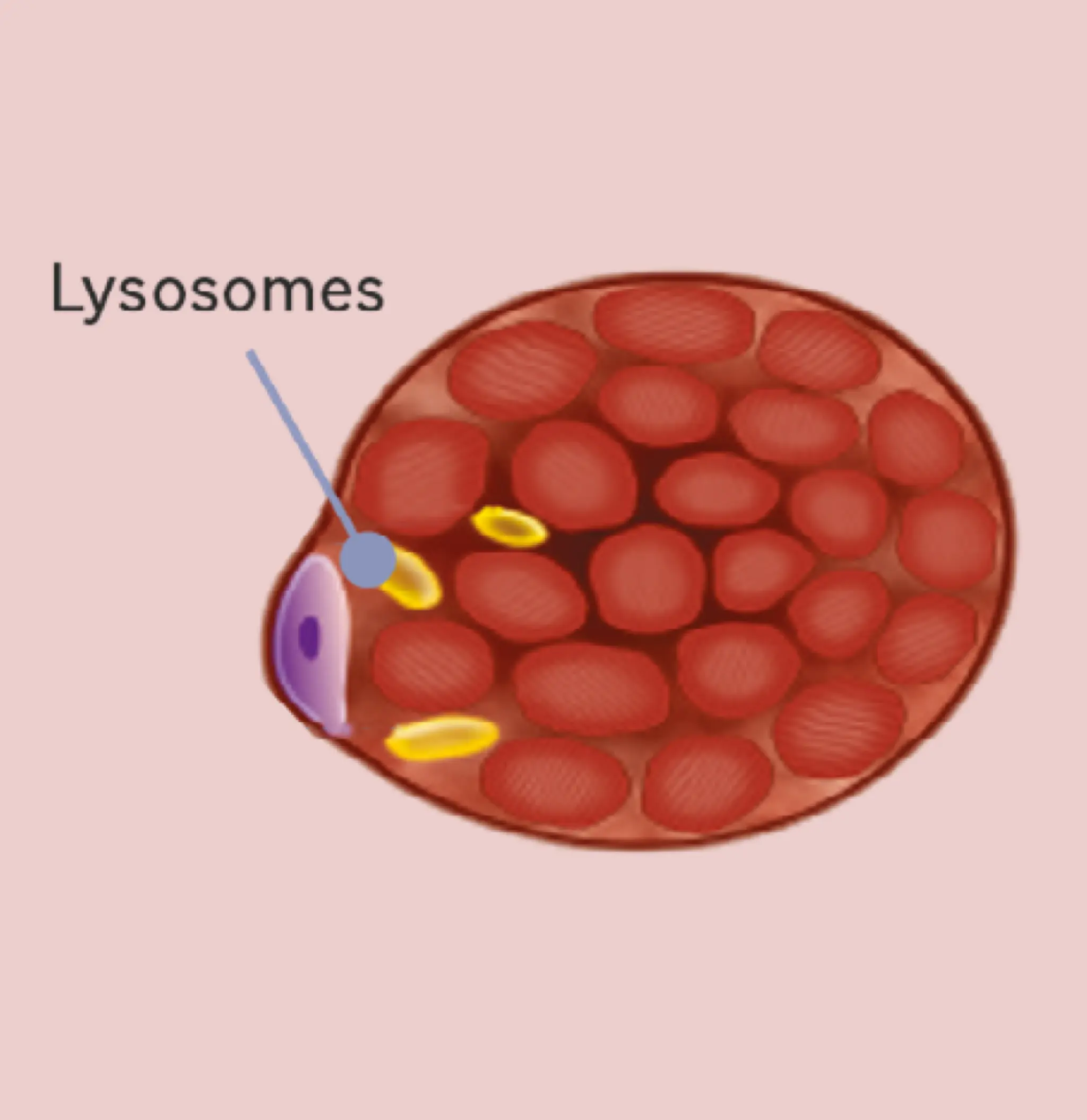 What is Pompe disease - Sanofi Campus UK