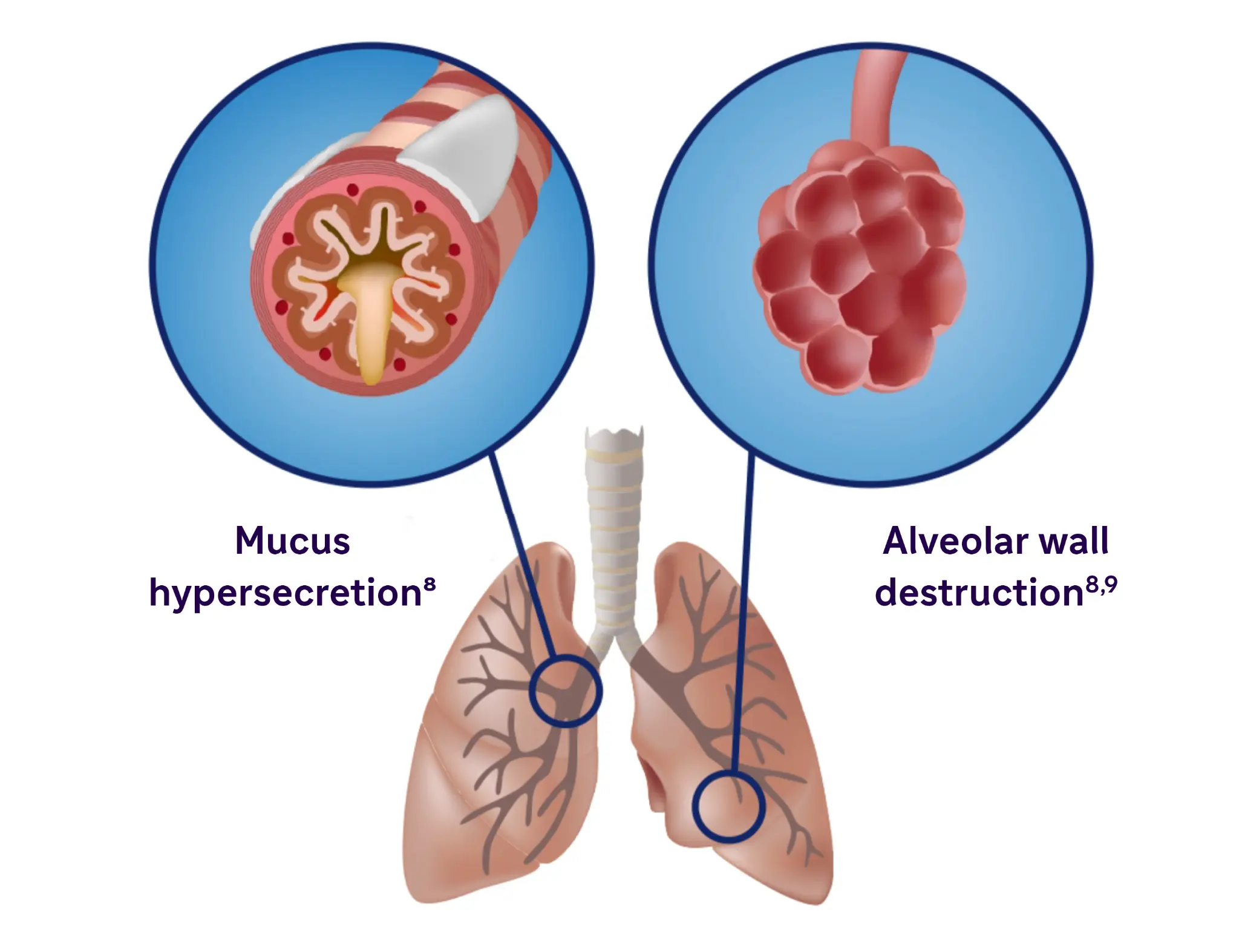 Role of type 2 inflammation in COPD | Campus Sanofi