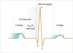 Infografik der Aufzeichnung eines EKG bei Morbus Fabry