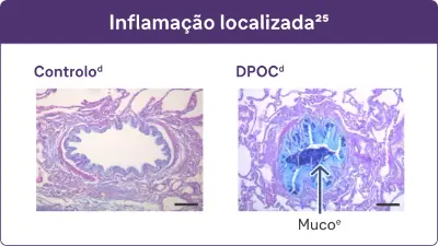 Papel da inflamação tipo 2 | Campus Sanofi