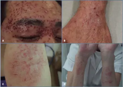 Tratamiento de dermatitis ezcema | Campus Sanofi