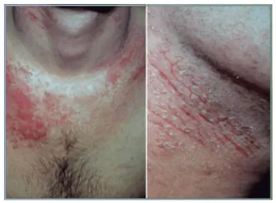 Eczema endógeno en dermatitis atópica | Campus Sanofi