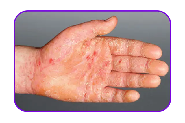 La dermatique atopique chez l’enfant et l’adolescent