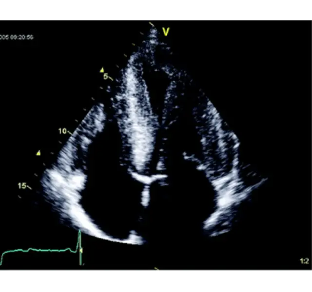 Comment évoquer une maladie de Fabry en cardiologie