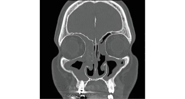 Quels outils pour évaluer la polypose naso-sinusienne