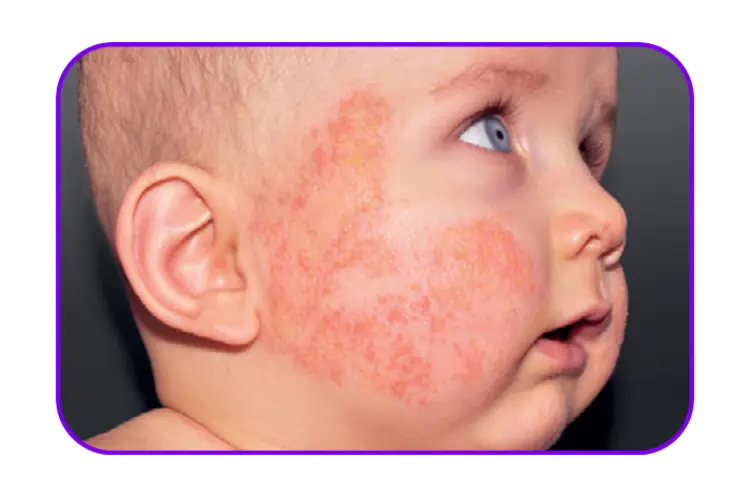 La dermatique atopique chez l’enfant et l’adolescent