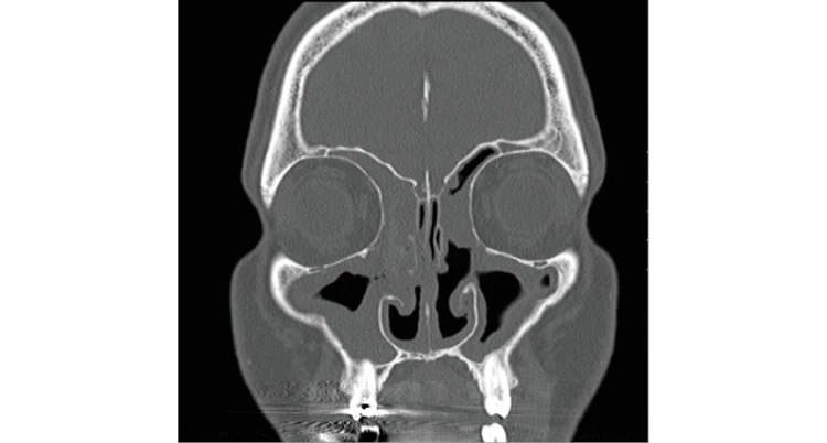 Quels outils pour évaluer la polypose naso-sinusienne