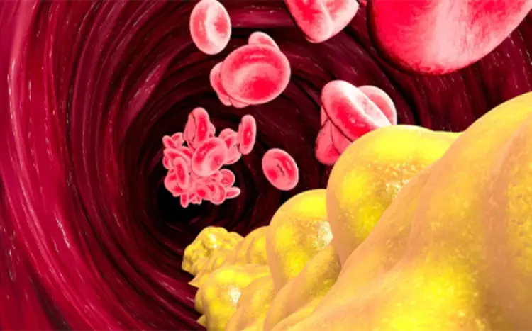 Evaluation of lipid management following ACS