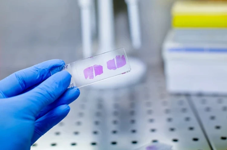 Diagnóstico de ASMD