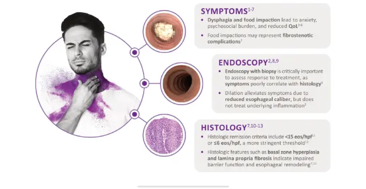 Key Disease Domains in EoE Assessment | Sanofi UAE