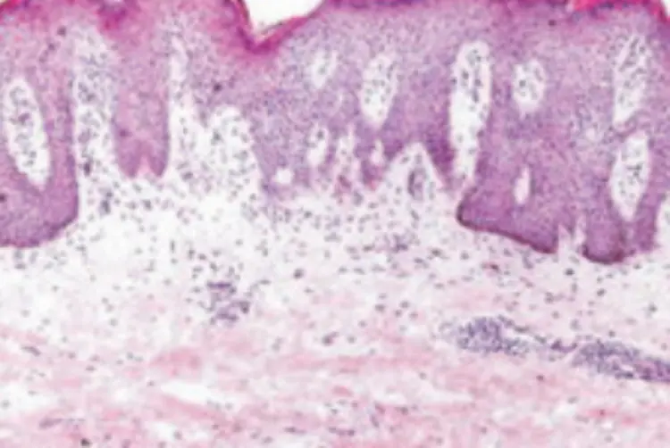 An Introduction to Atopic Dermatitis – Sanofi Campus+ UK healthcare ...