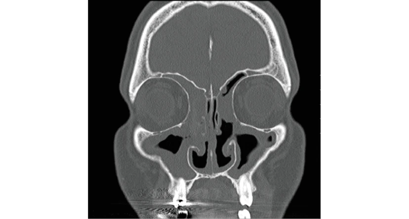Quels outils pour évaluer la polypose naso-sinusienne