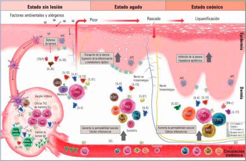 Dermatitis atópica: concepto, diagnóstico y abordaje clínico