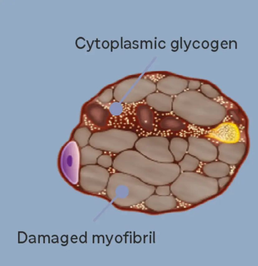 What is Pompe disease - Sanofi Campus UK