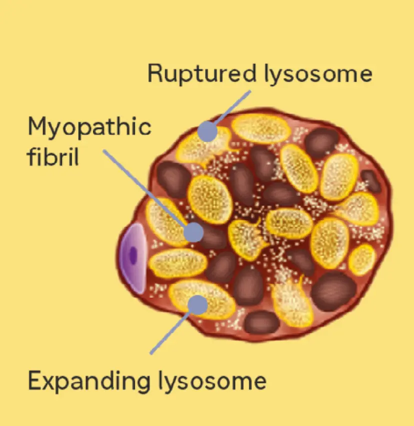 What is Pompe disease - Sanofi Campus UK
